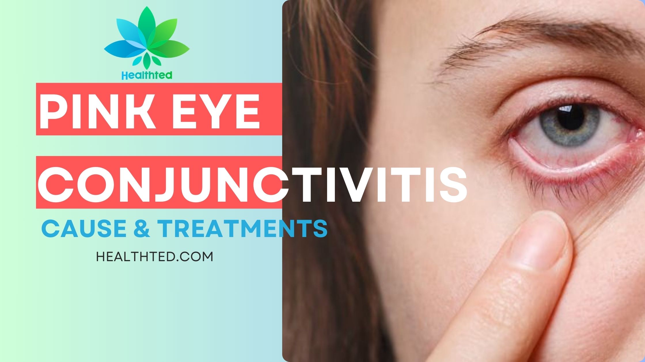 Pink Eye : Causes and Cure » HealthTED